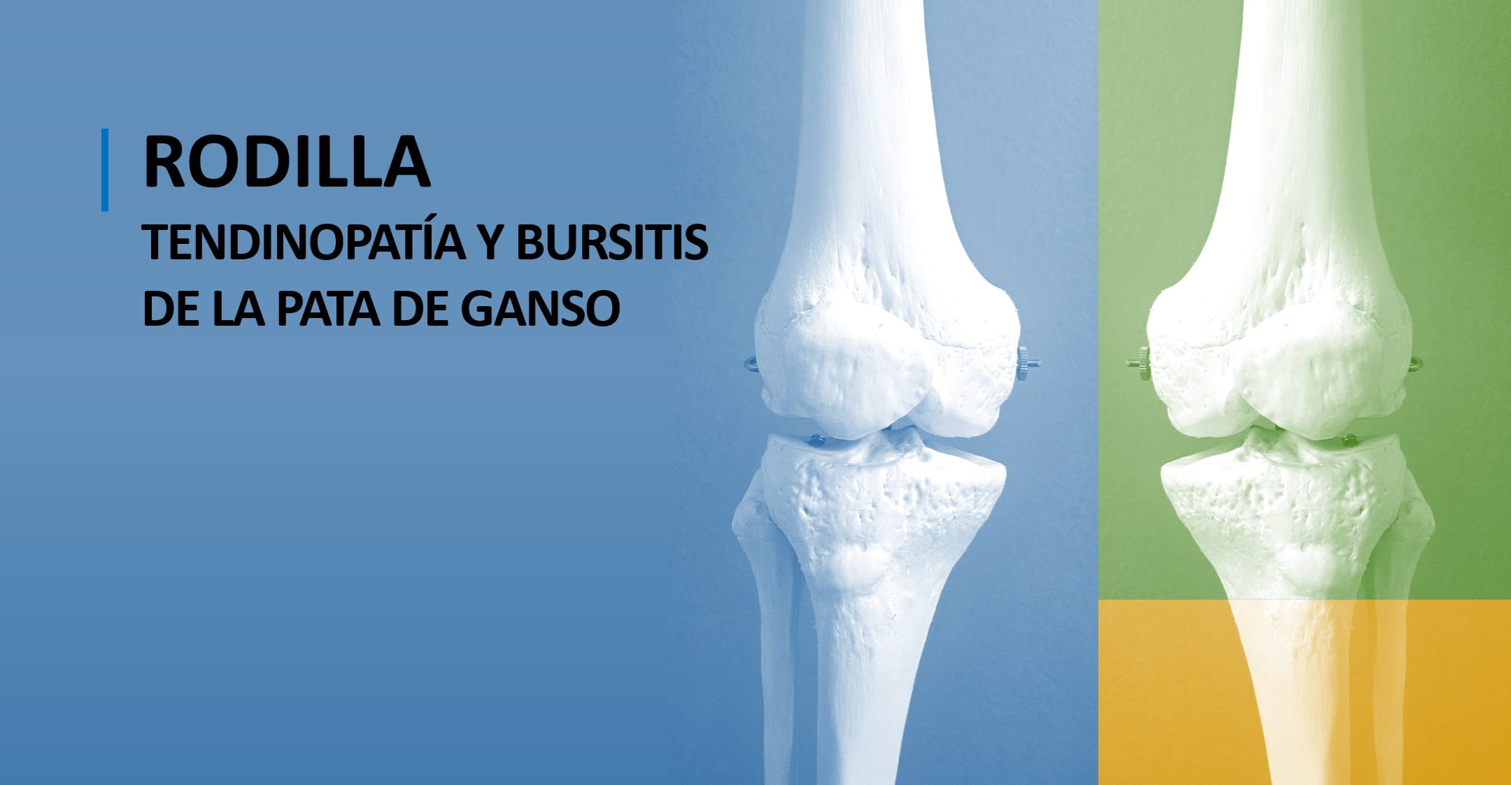 Bursitis de la pata de ganso: causas y tratamiento