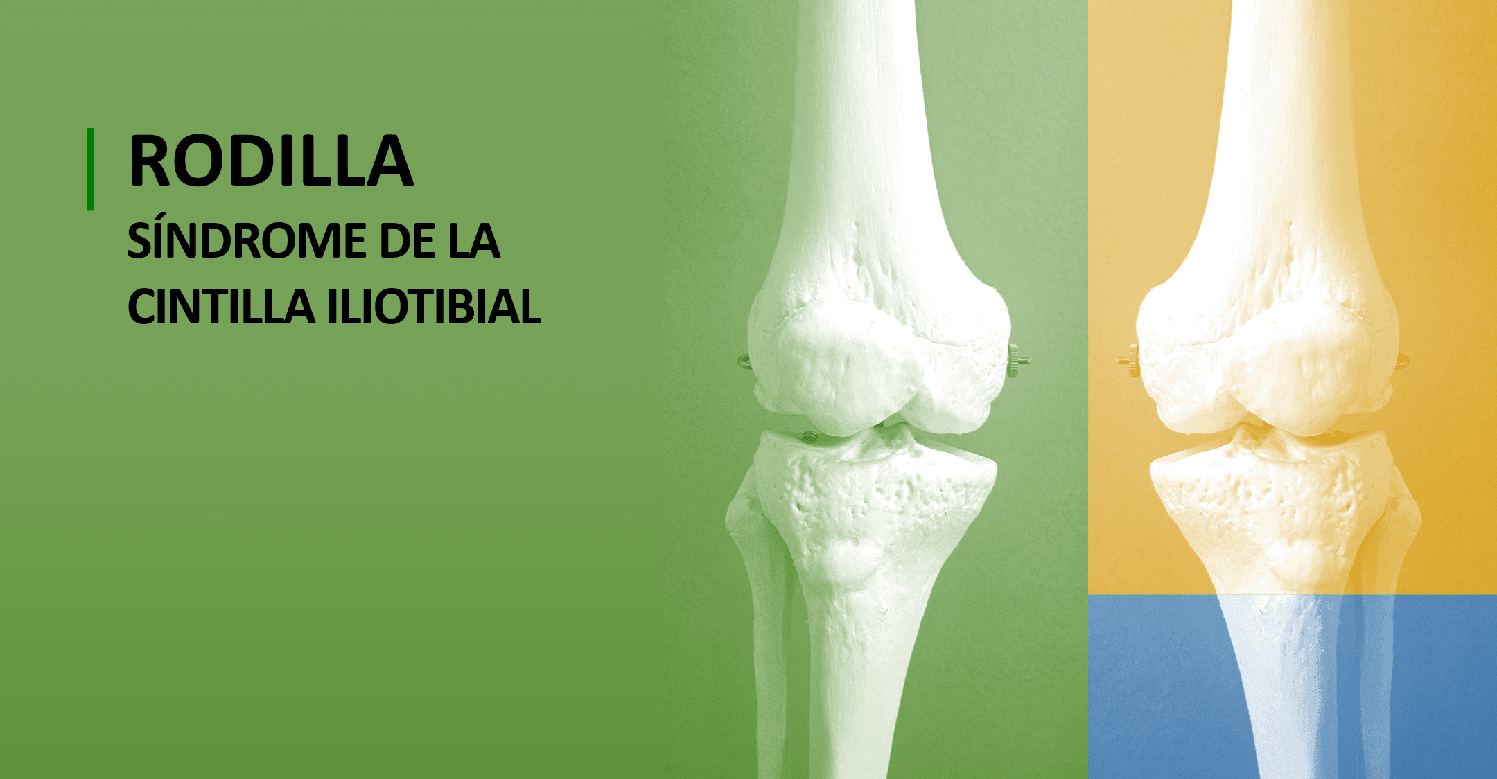 Síndrome de la cintilla iliotibial en corredores